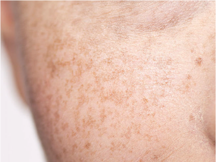 Tight Skin without Scars Lebanon, BBL Hero Laser